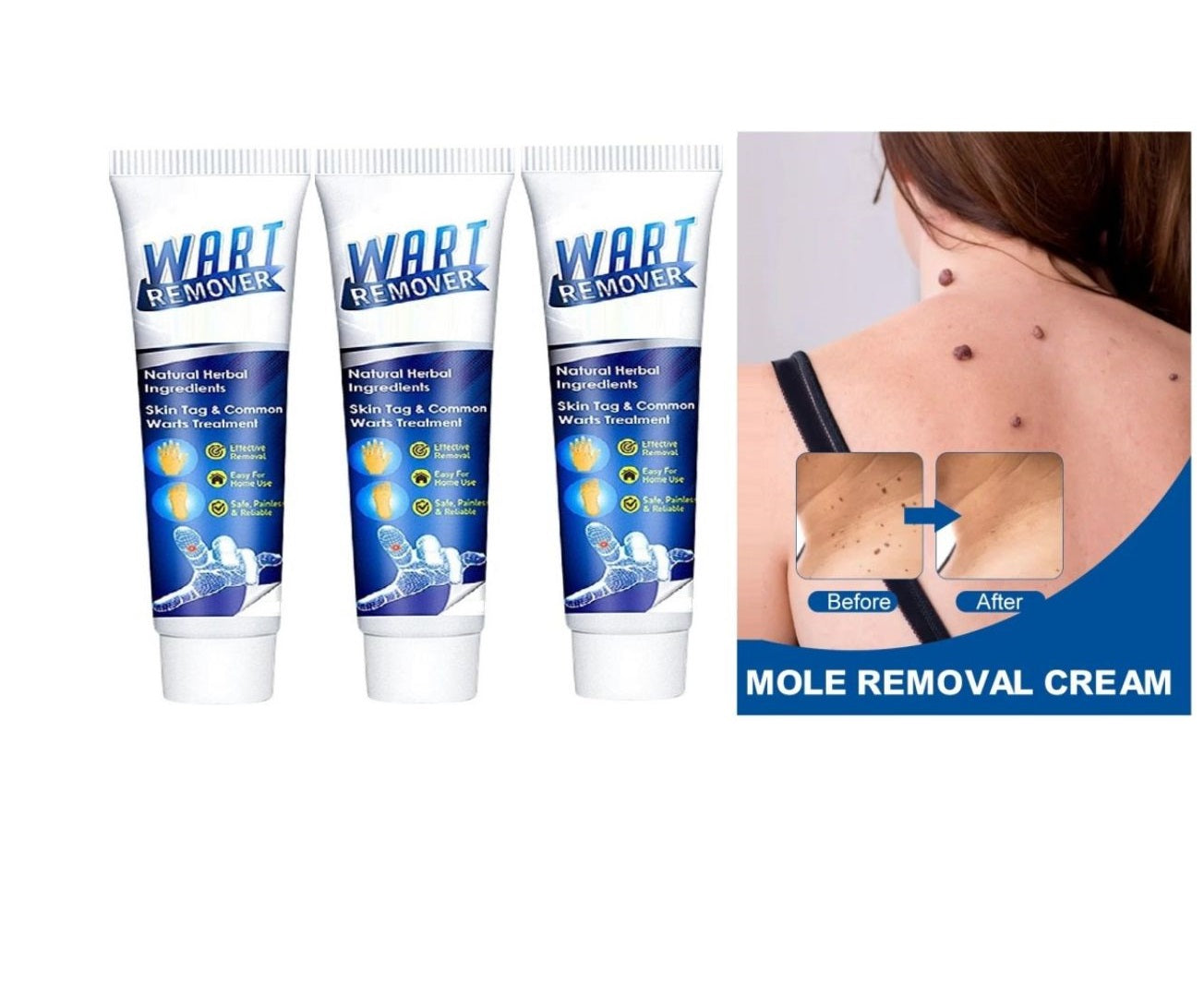 Warts Remover Cream Extract Skin Face Tag Extract Corn Treatment Ointm ...